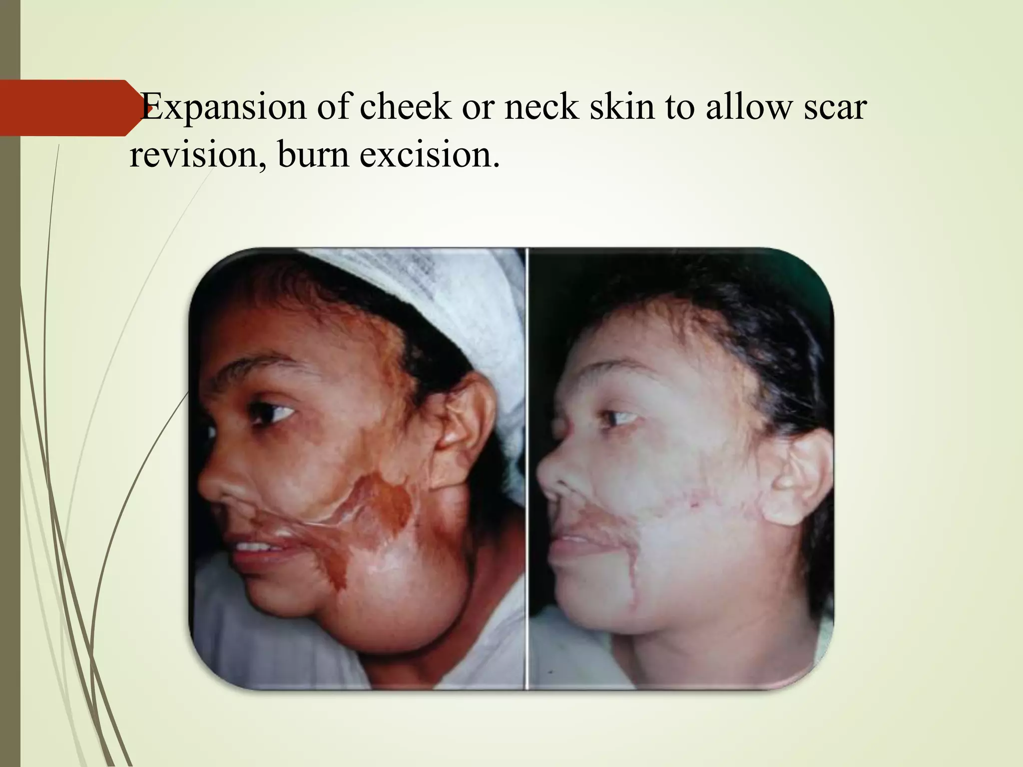 Tissue expanders in oral and maxillofacial surgery | PPTX