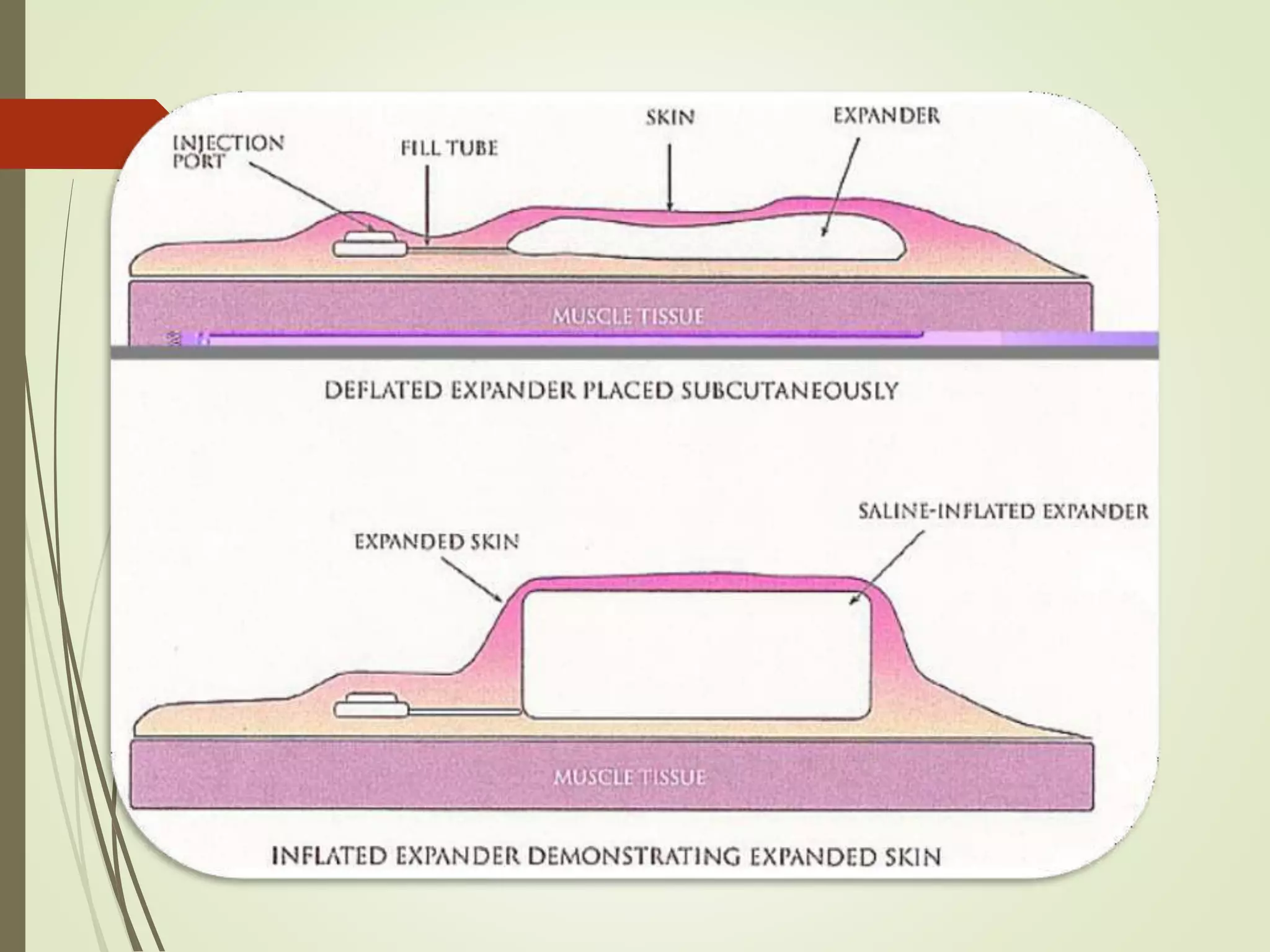 Tissue expanders in oral and maxillofacial surgery | PPTX | Skin and ...