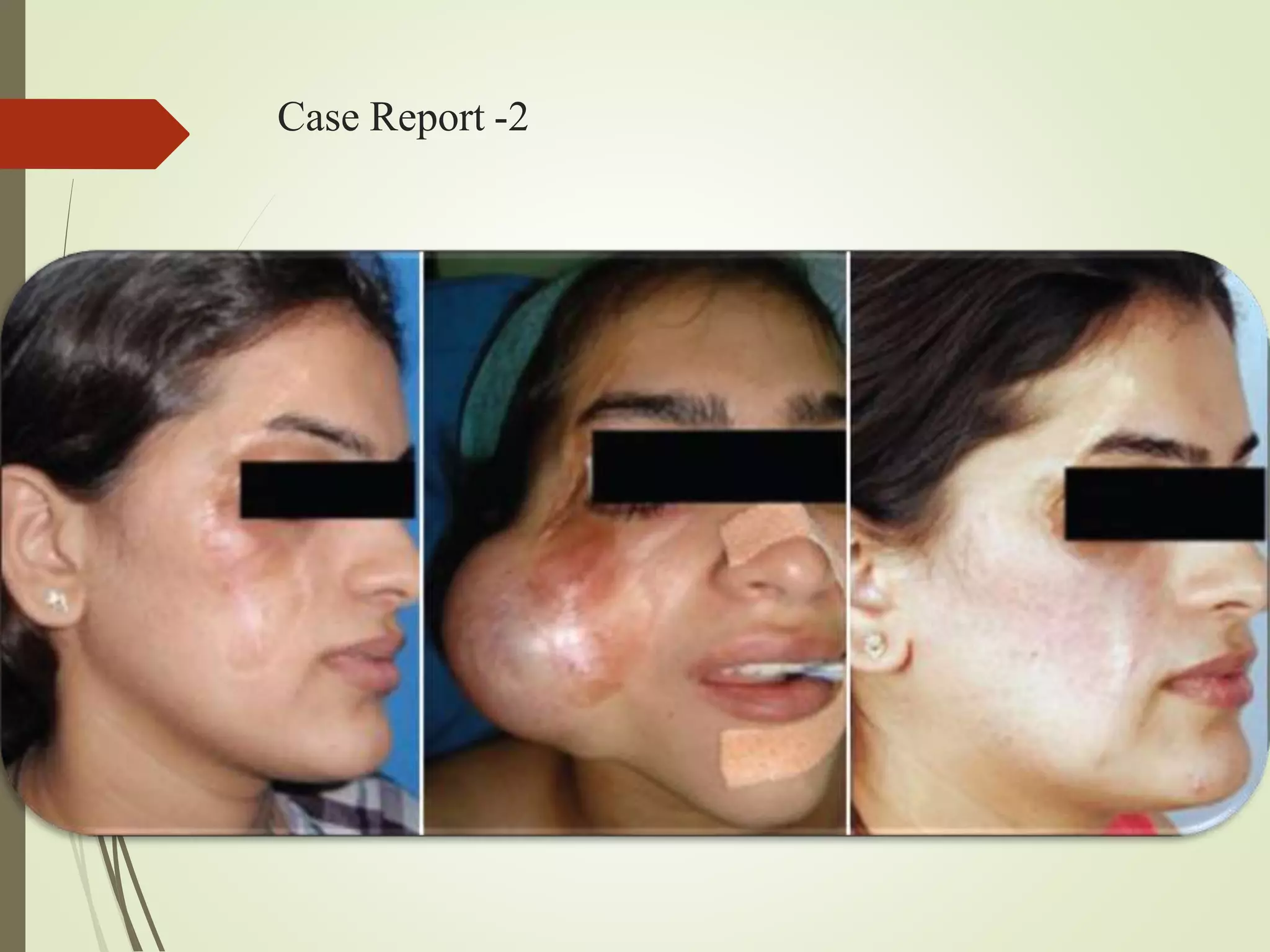 Tissue expanders in oral and maxillofacial surgery | PPTX