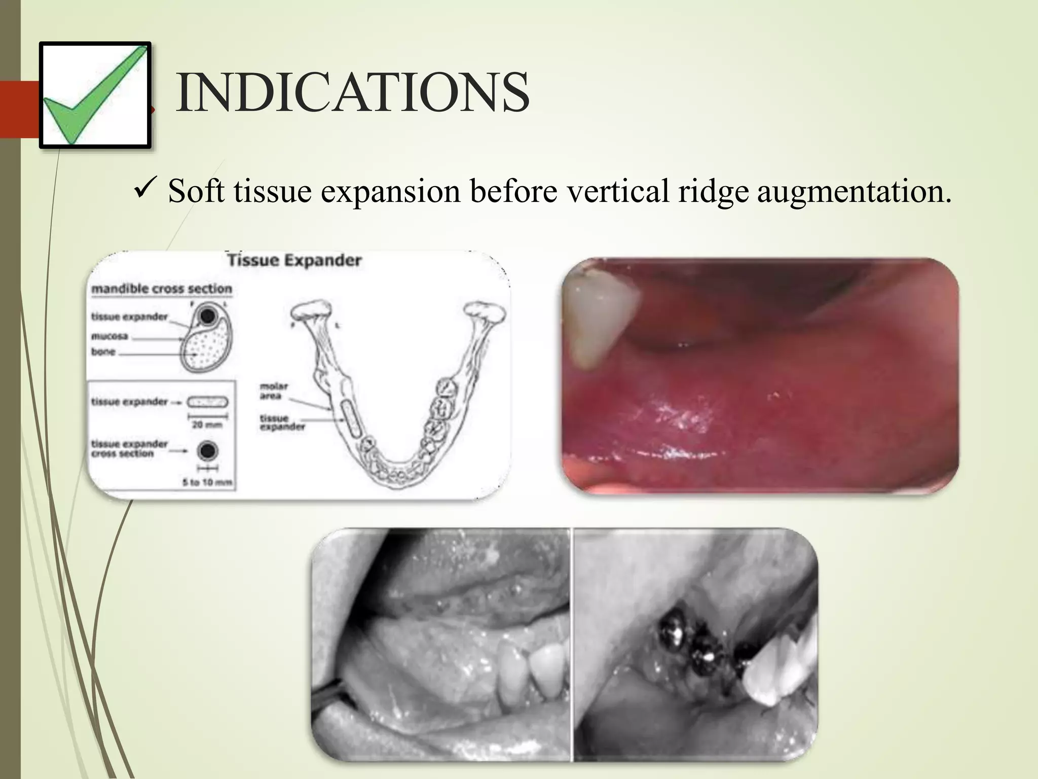 Tissue expanders in oral and maxillofacial surgery | PPTX