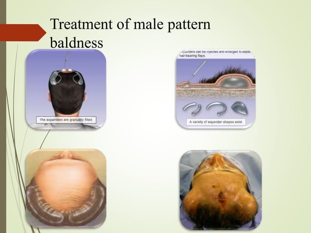 Tissue expanders in oral and maxillofacial surgery | PPTX | Skin and ...