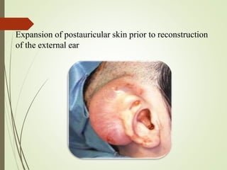 Tissue expanders in oral and maxillofacial surgery | PPTX
