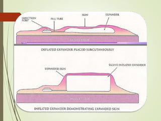 Tissue expanders in oral and maxillofacial surgery | PPTX