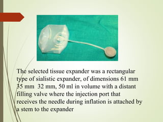 Tissue expanders in oral and maxillofacial surgery | PPTX
