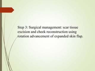 Tissue expanders in oral and maxillofacial surgery | PPTX