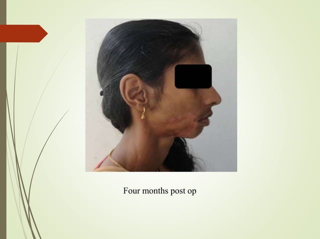 Tissue expanders in oral and maxillofacial surgery | PPTX | Skin and ...