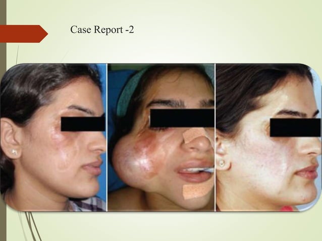 Tissue expanders in oral and maxillofacial surgery | PPTX | Skin and ...