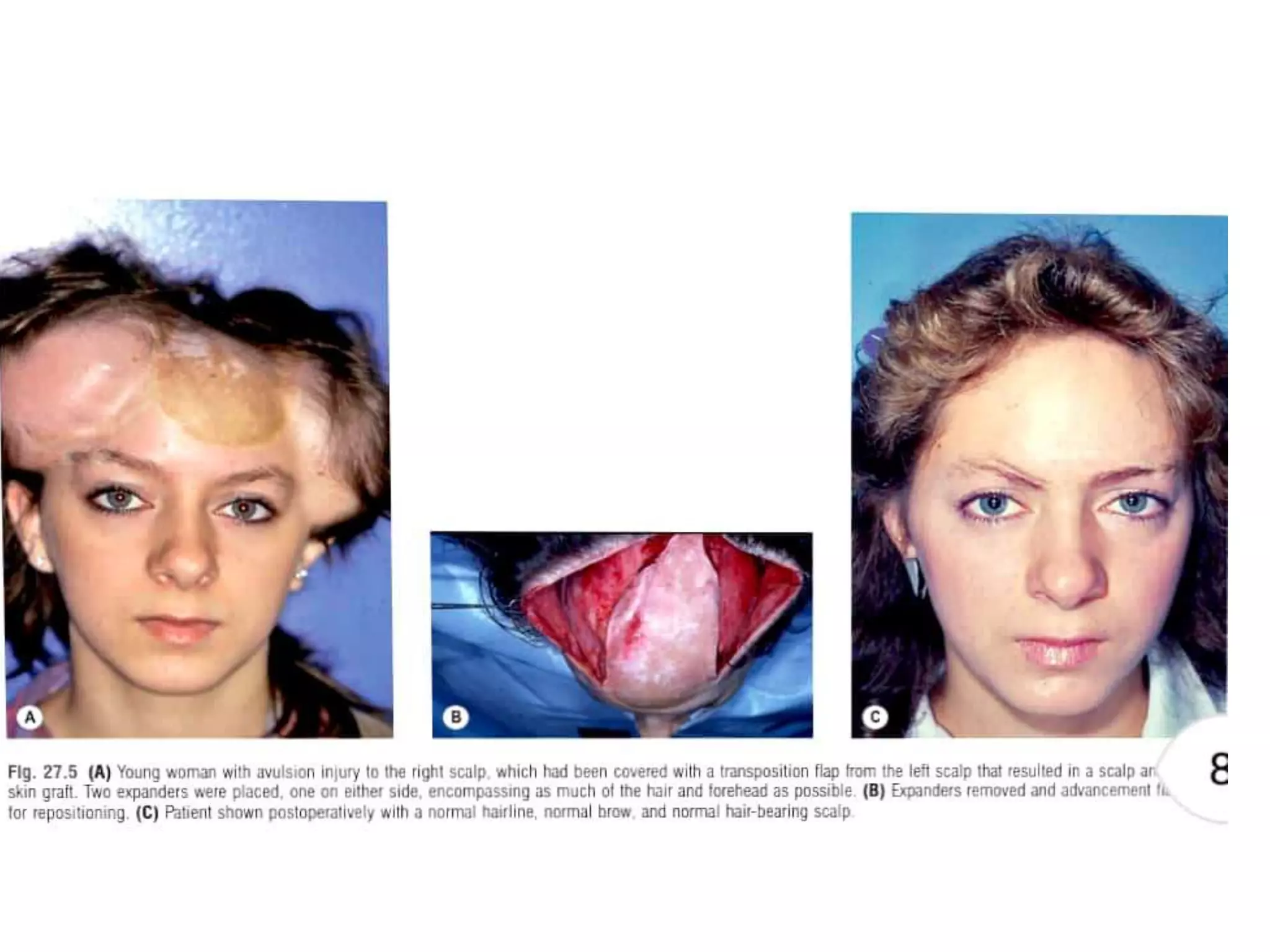 Tissue expansion | PPTX