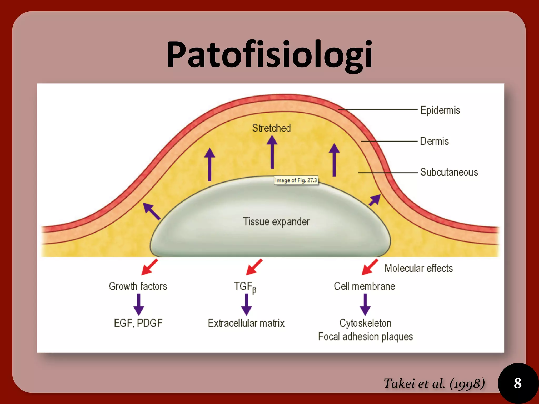 Tissue Expansion | PDF