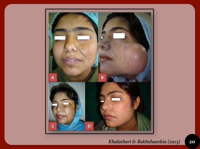 Tissue Expansion | PPT