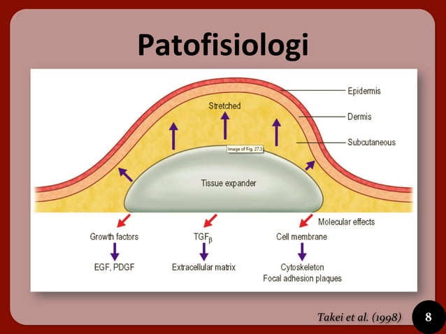 Tissue Expansion | PPT
