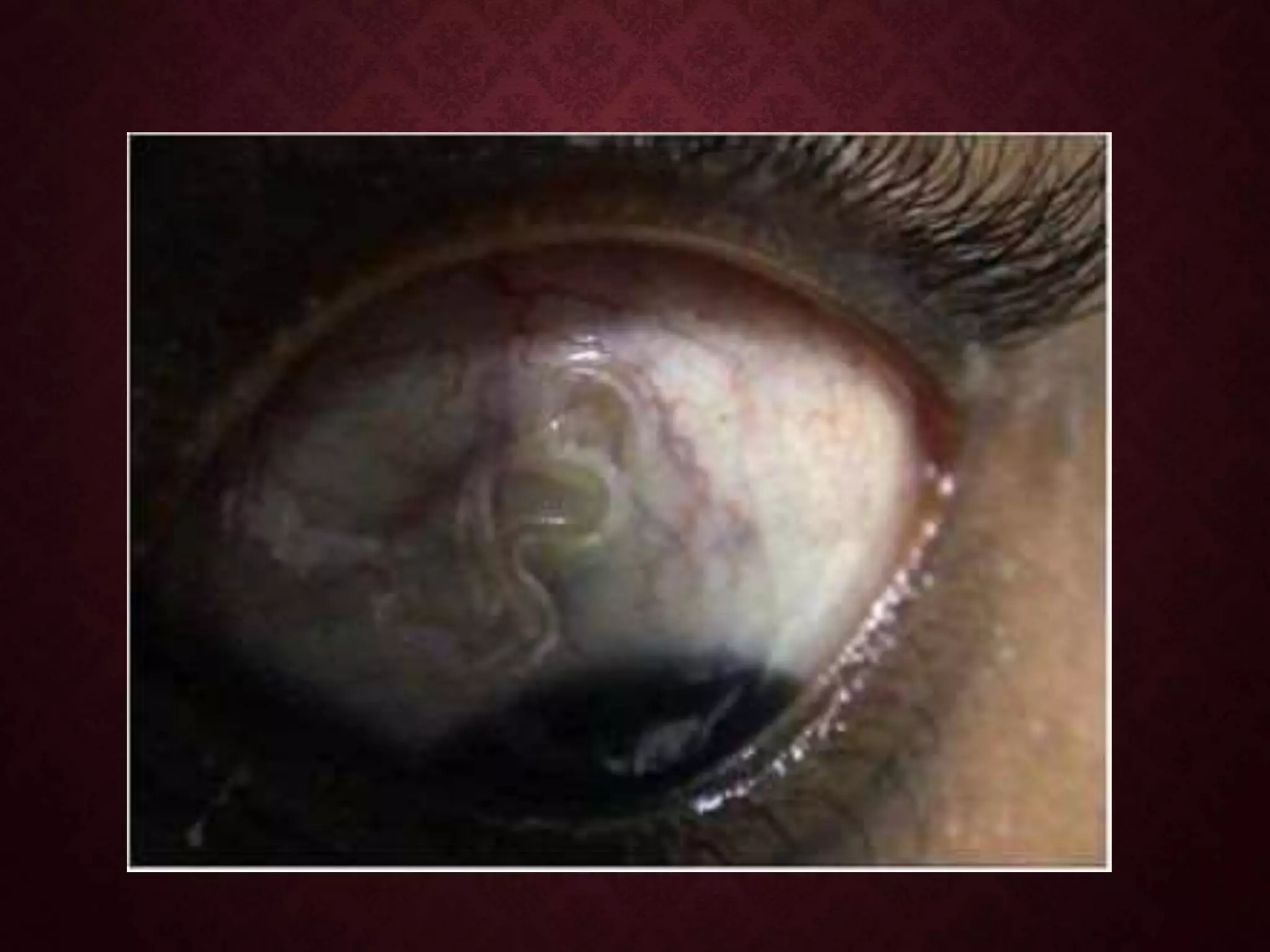 Tissue nematodes | PPSX