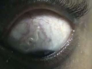Onchocerca Volvulus Eye