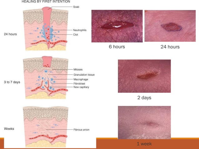 Robbins Basic Pathology - Tissue Repair | PPT