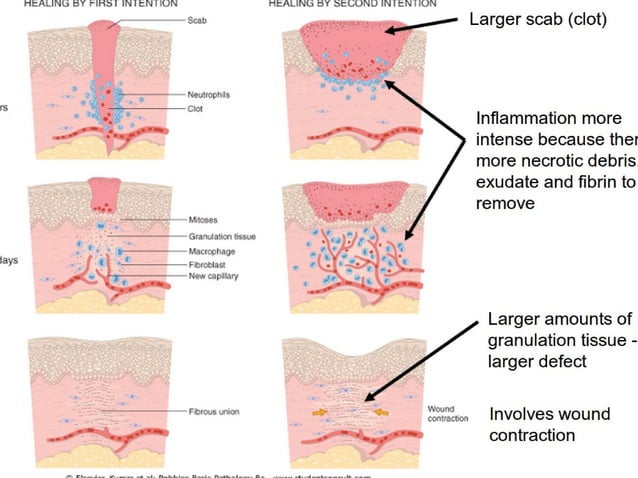 Tissue repair, regeneration and wound healing (1) | PPT | Biological ...