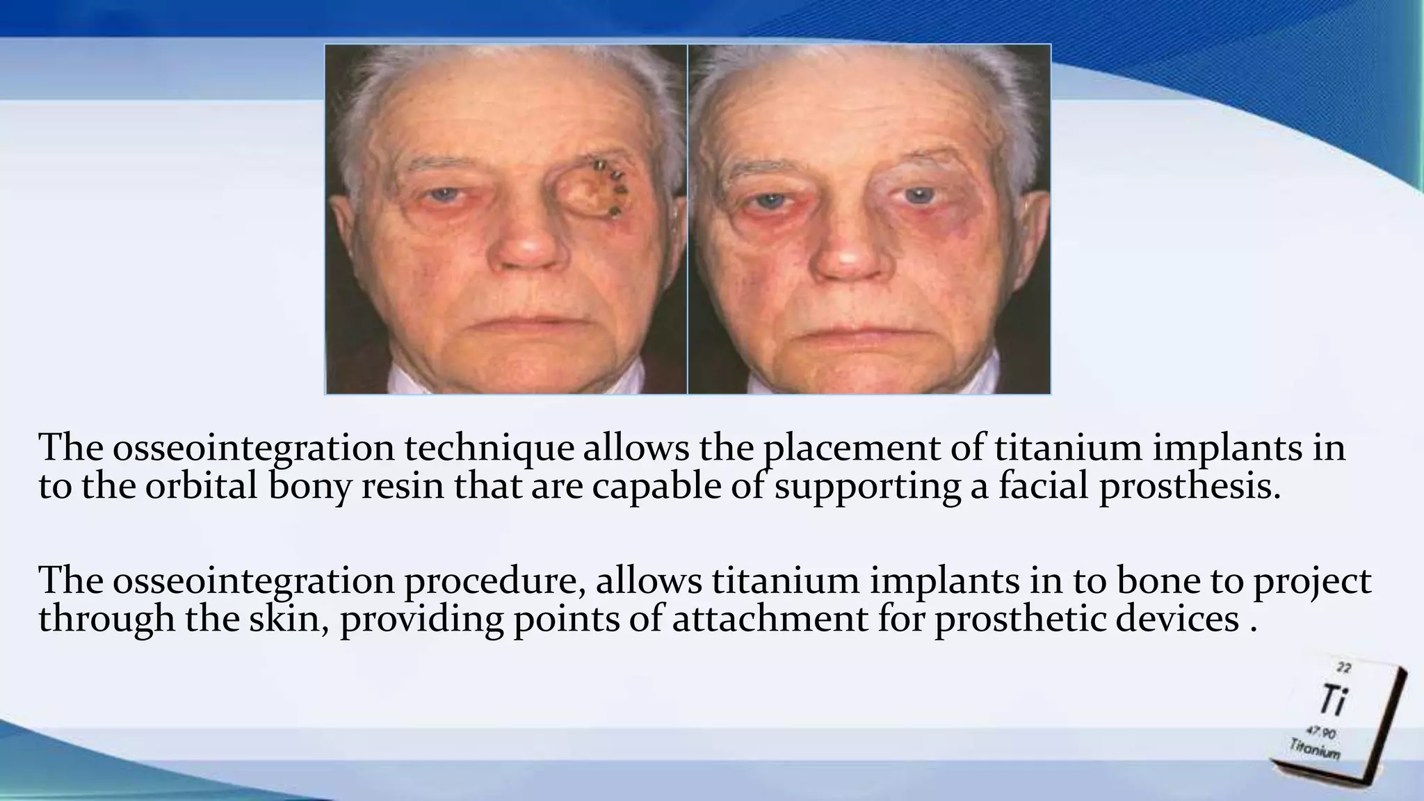 Titanium Alloys: Clinical Applications | PPTX