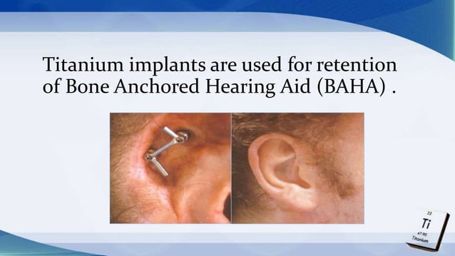 Titanium Alloys: Clinical Applications | PPTX | Dental Health ...
