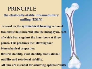 Titanium elastic nail | PPT | Free Download