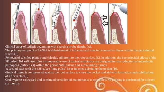 periodontal flap surgeries