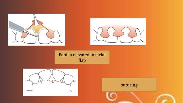 periodontal flap surgeries