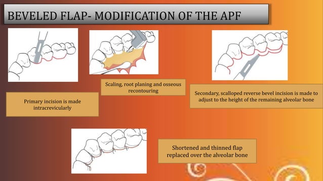 periodontal flap surgeries