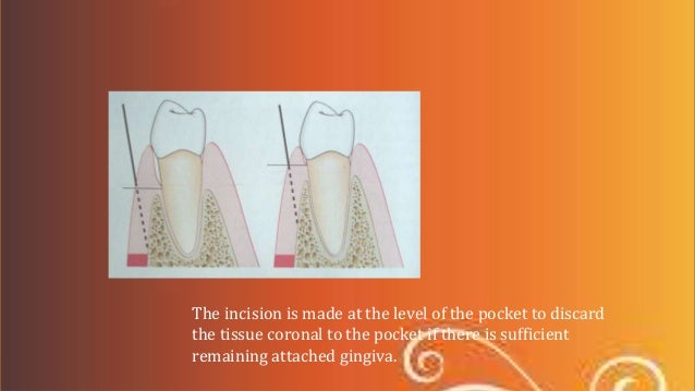 periodontal flap surgeries