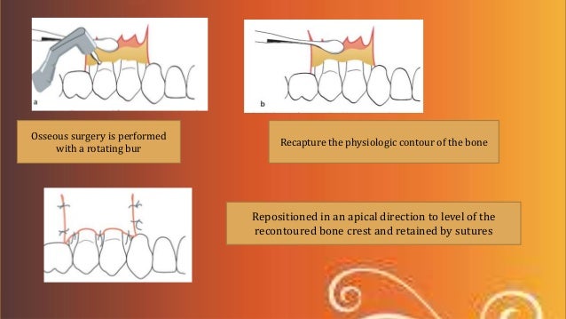 periodontal flap surgeries