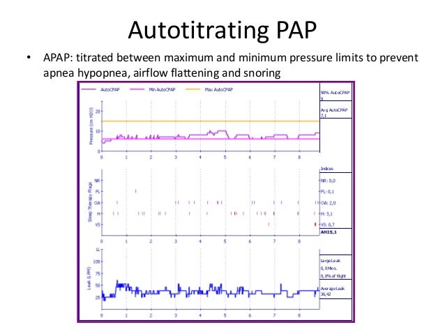 Titration study in sleep lab