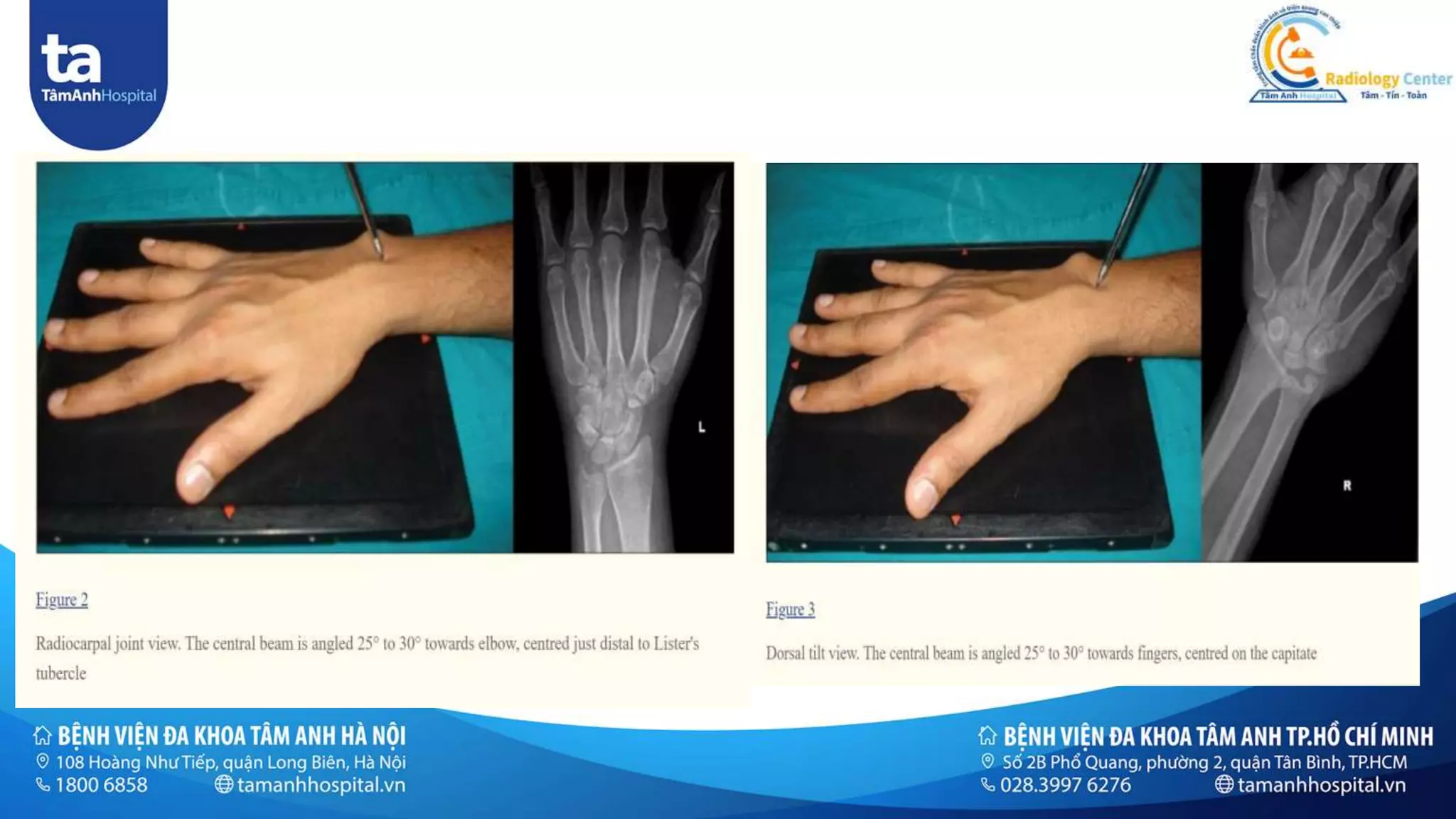 Tiêu chuẩn, kỹ thuật chụp XQuang cổ tay.pptx