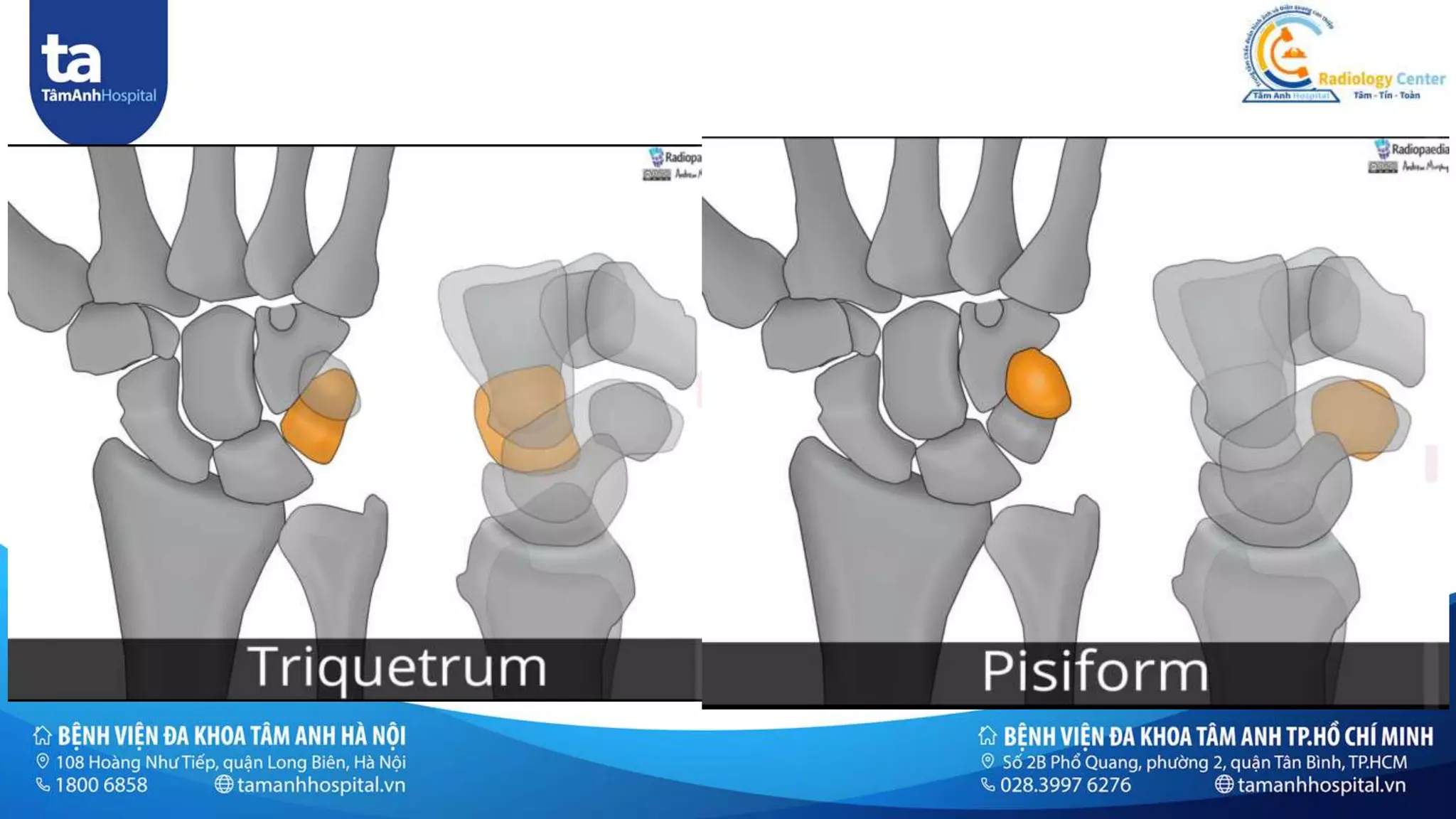 Tiêu chuẩn, kỹ thuật chụp XQuang cổ tay.pptx