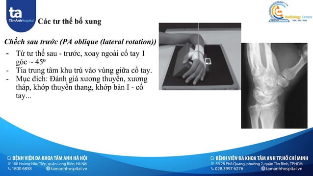 Tiêu chuẩn, kỹ thuật chụp XQuang cổ tay.pptx