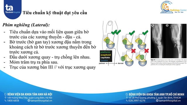 Tiêu chuẩn, kỹ thuật chụp XQuang cổ tay.pptx
