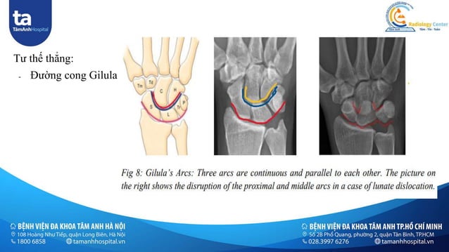 Tiêu chuẩn, kỹ thuật chụp XQuang cổ tay.pptx