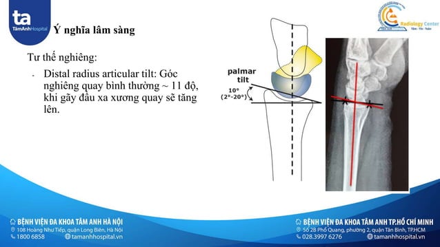 Tiêu chuẩn, kỹ thuật chụp XQuang cổ tay.pptx