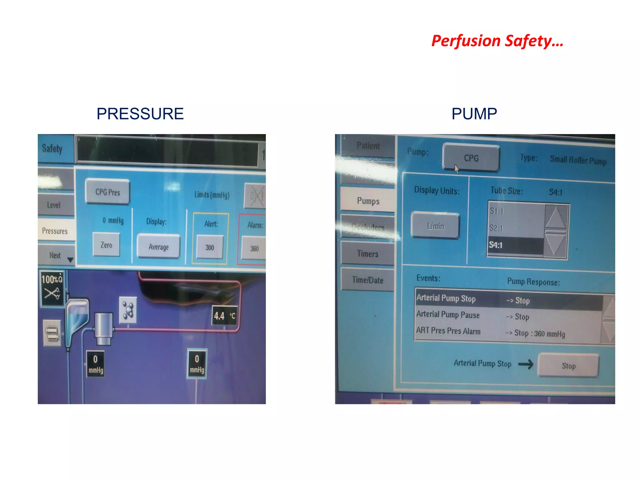 cardioplegia delivery management, perfusion safety | PPT