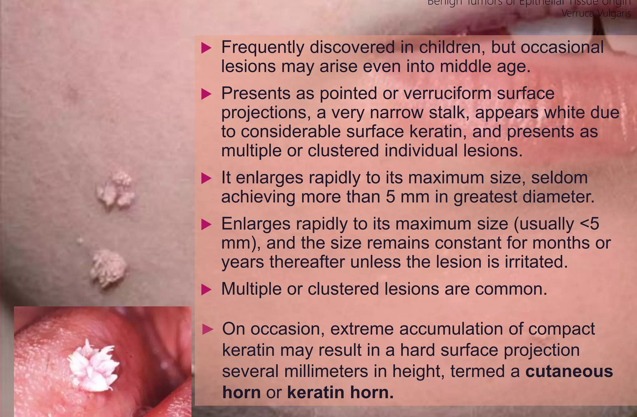 Benign tumors of oral cavity sonal | PPTX