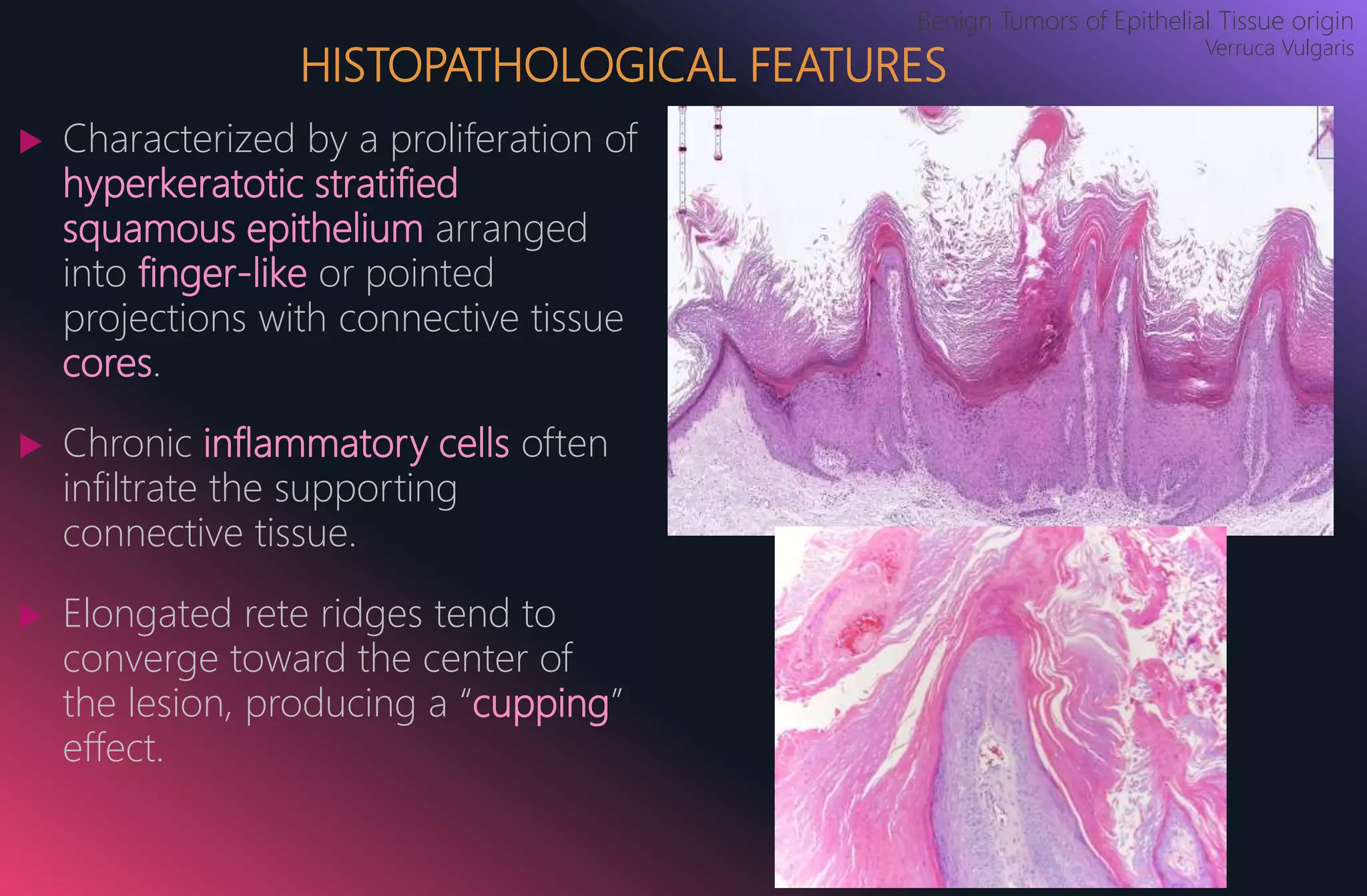 Benign tumors of oral cavity sonal | PPTX