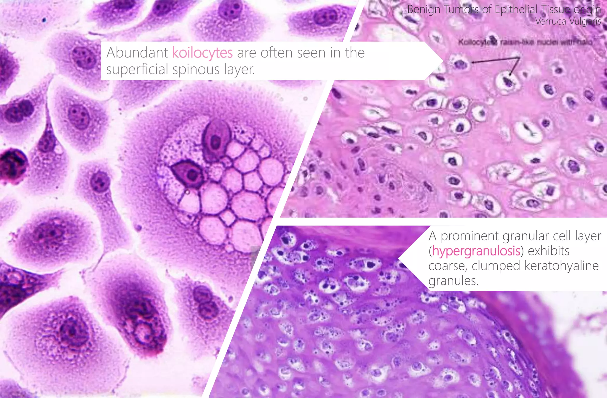 Benign tumors of oral cavity sonal | PPTX