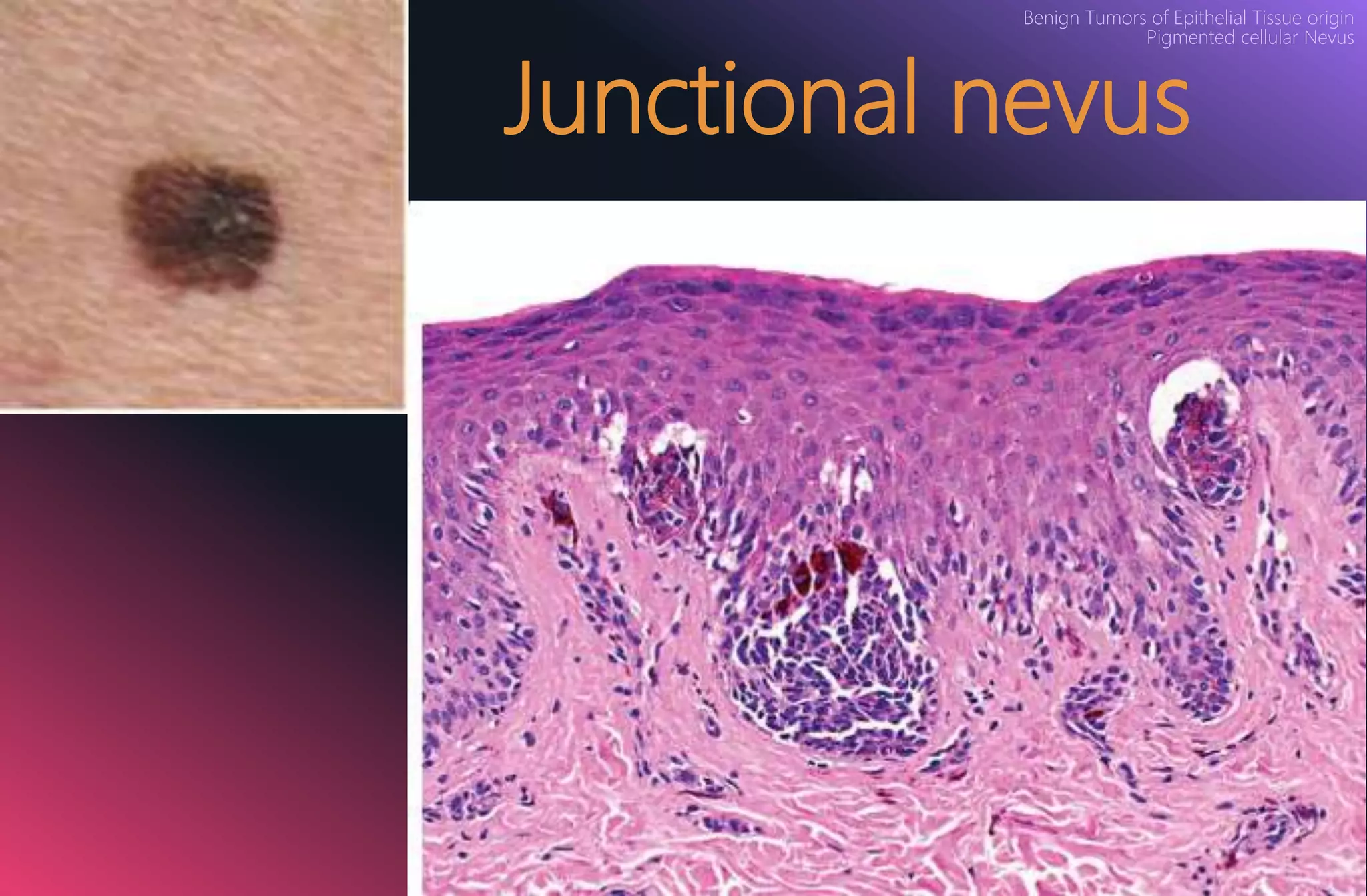 Benign tumors of oral cavity sonal | PPTX