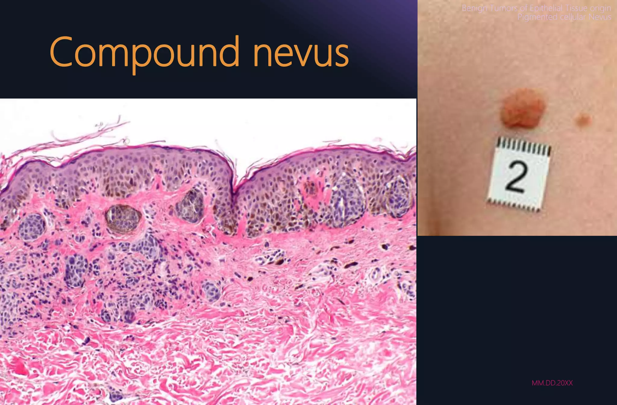 Benign tumors of oral cavity sonal | PPTX