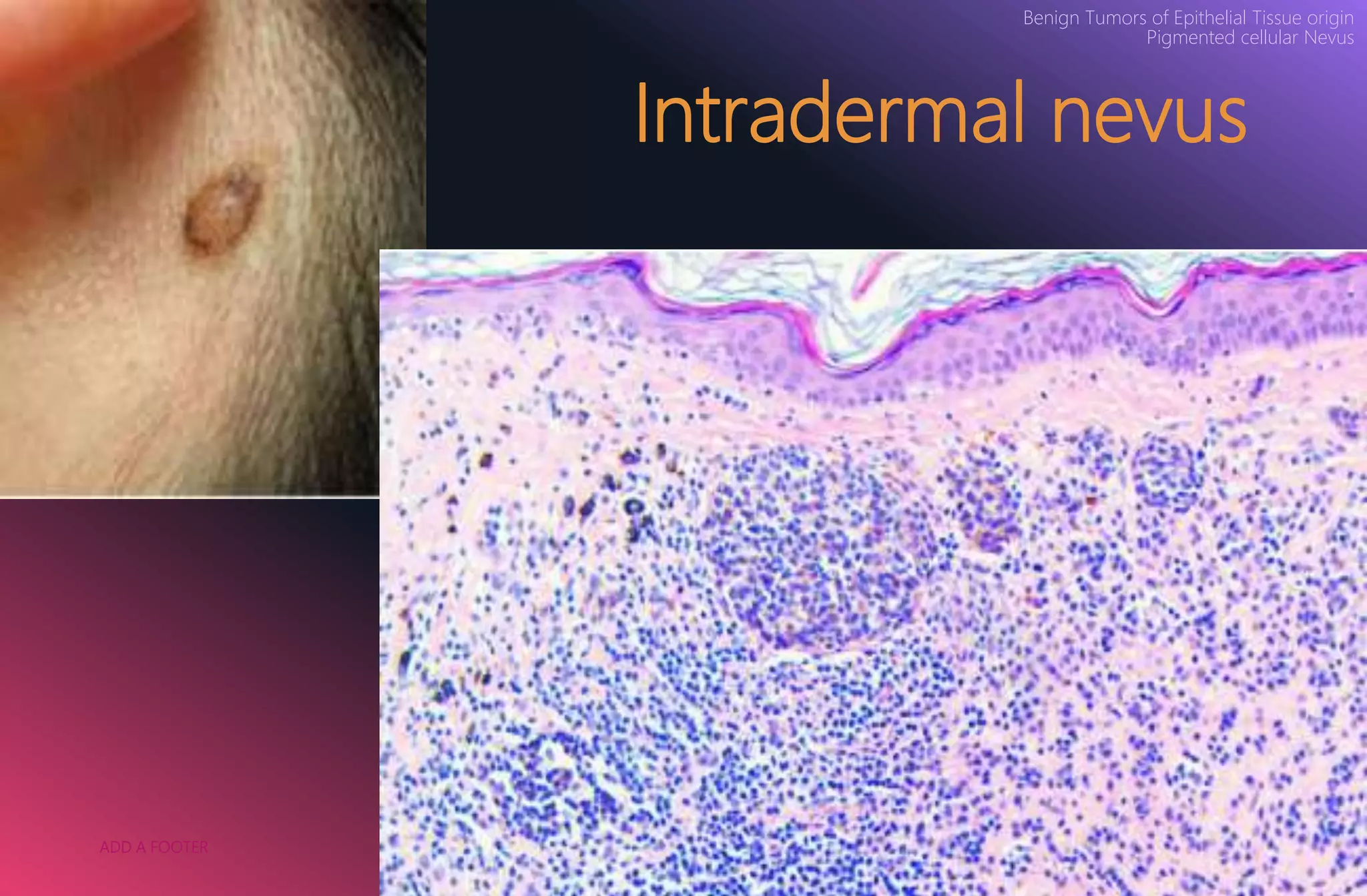Benign tumors of oral cavity sonal | PPTX