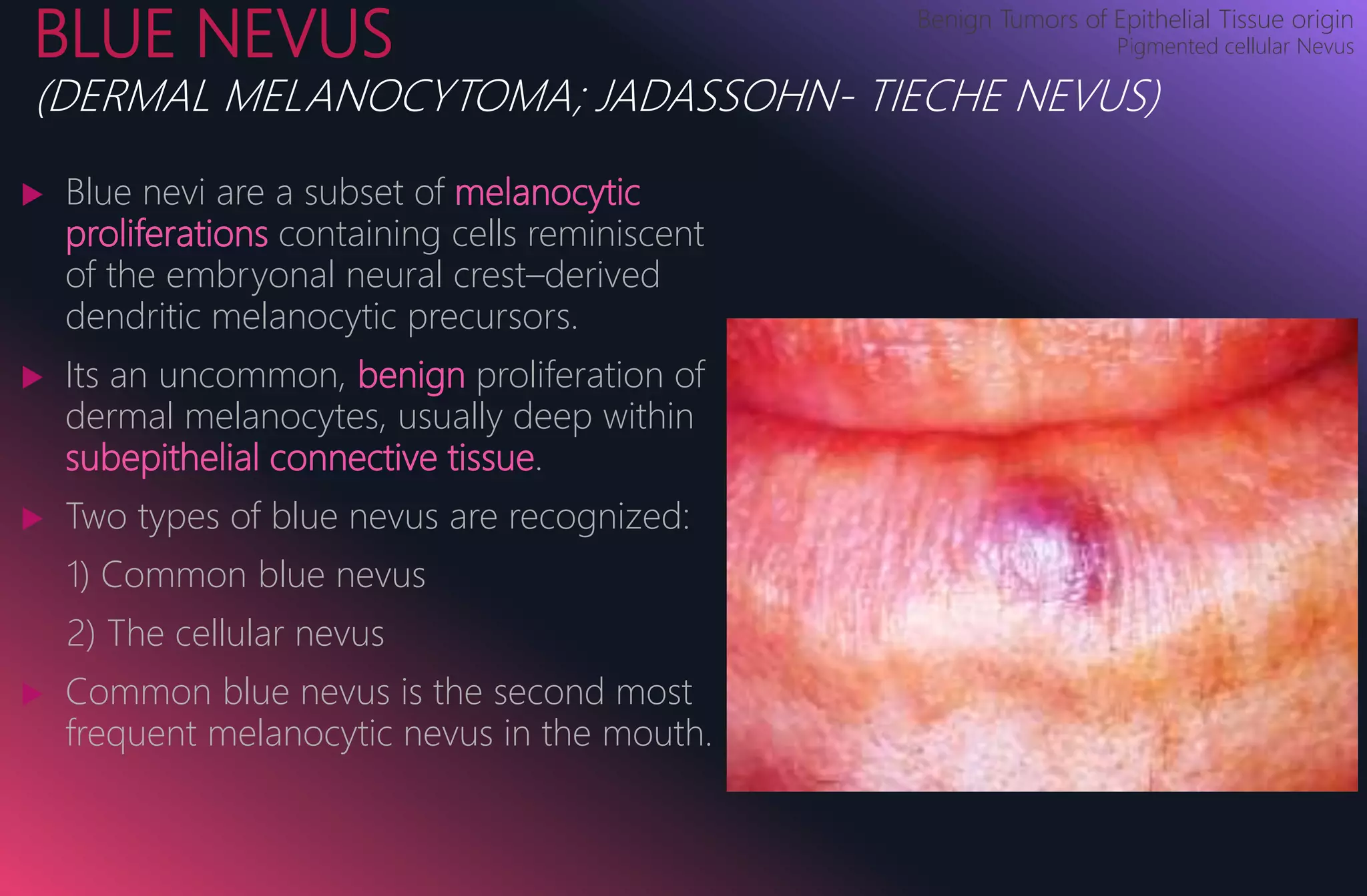 Benign tumors of oral cavity sonal | PPTX