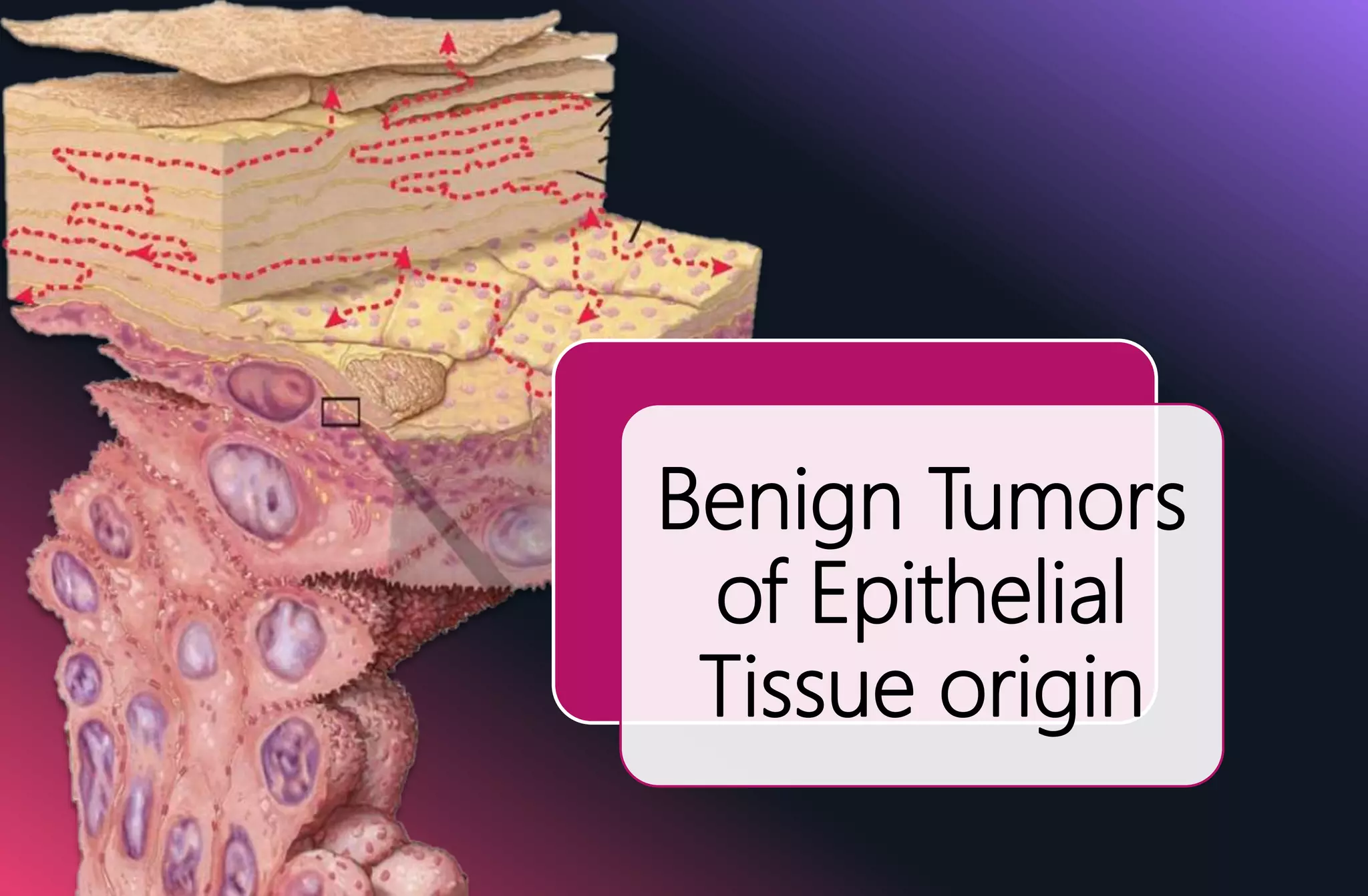 Benign tumors of oral cavity sonal | PPTX