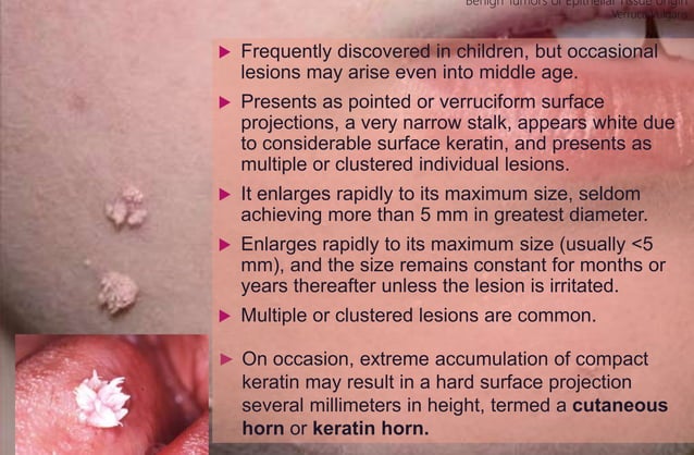 Benign tumors of oral cavity sonal | PPTX | Dental Health | Diseases ...