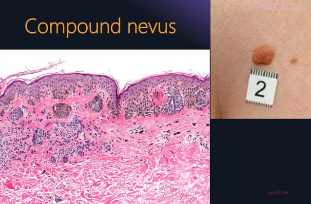 Benign tumors of oral cavity sonal | PPTX | Dental Health | Diseases ...