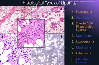 Benign tumors of oral cavity sonal | PPTX