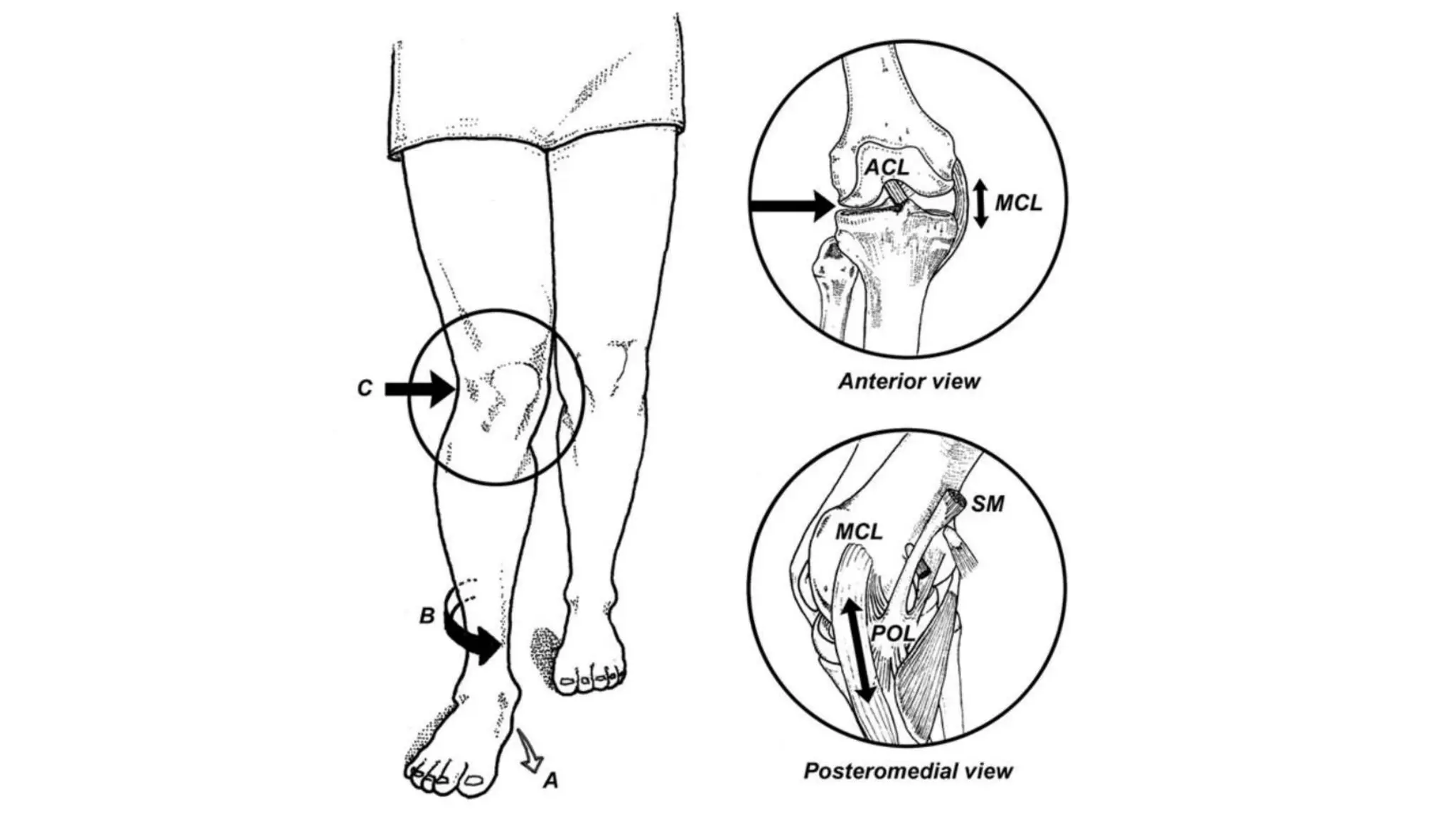 TKA in valgus knee.pptx