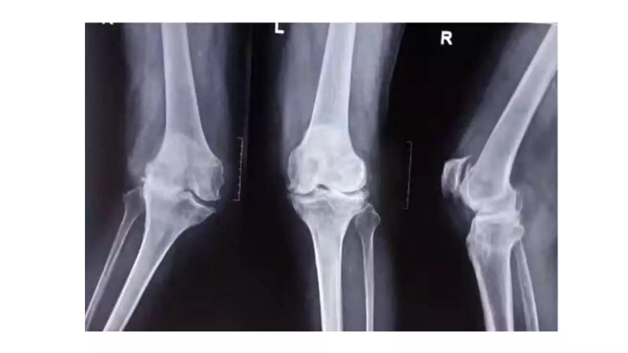 TKA in valgus knee.pptx