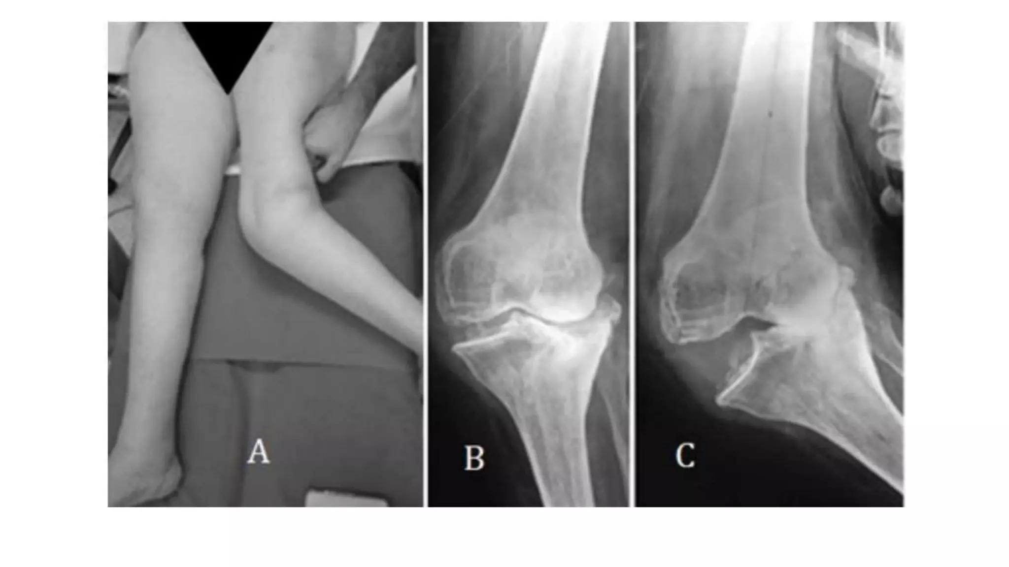 TKA in valgus knee.pptx
