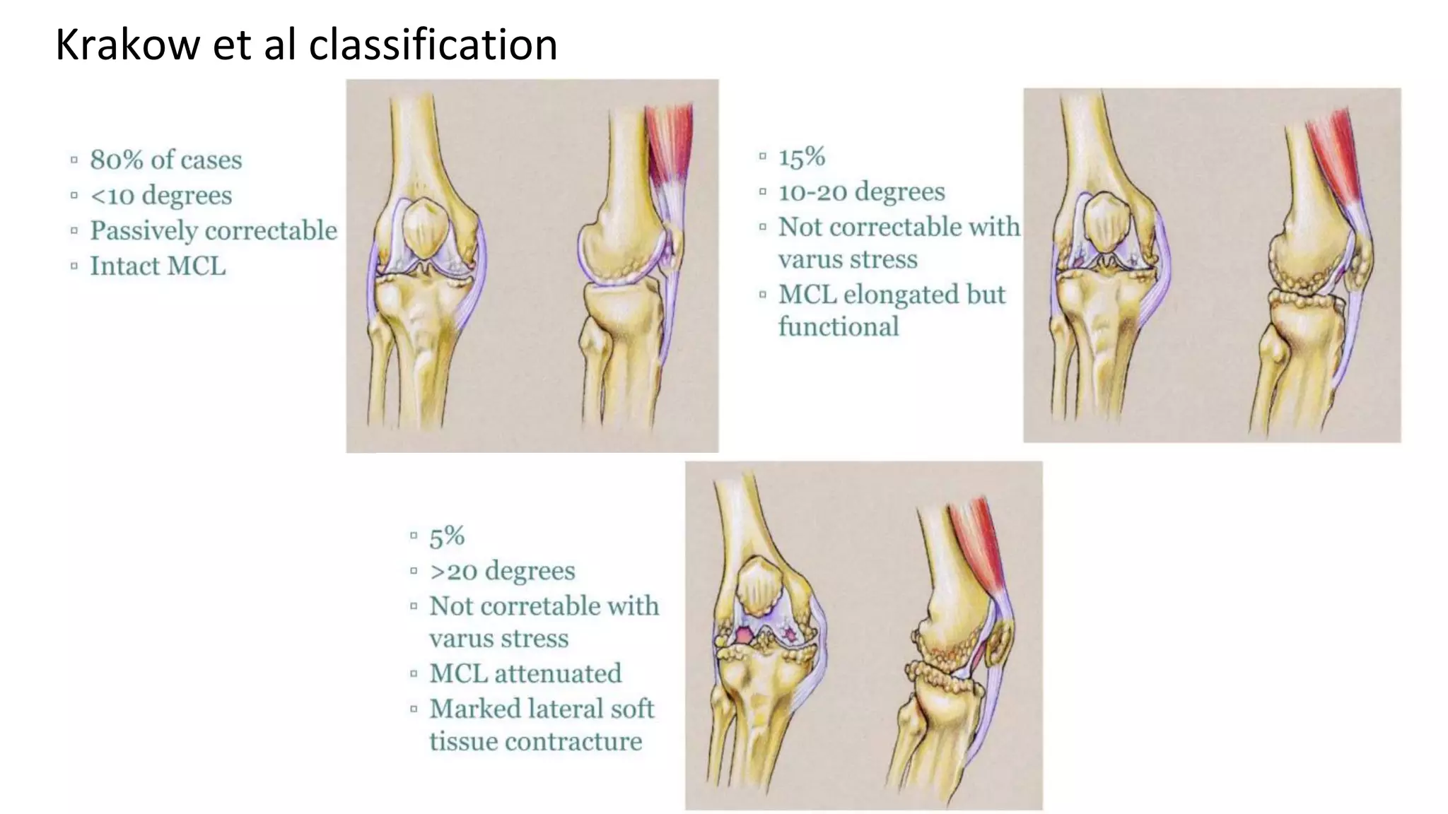 TKA in valgus knee.pptx